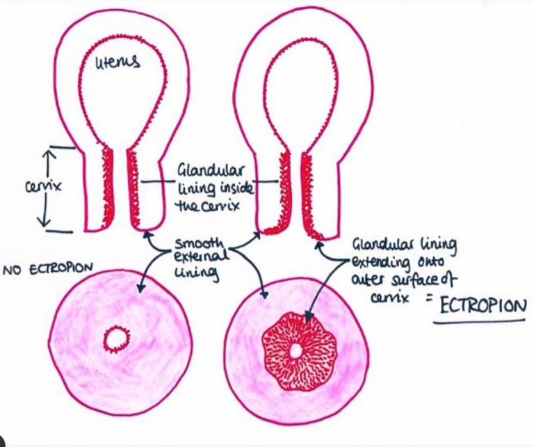 Cervical Ectropion Symptoms, Causes & Treatment - The Lowdown