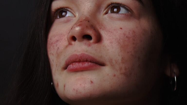 What's The Best Contraceptive Pill For Acne? | The Lowdown